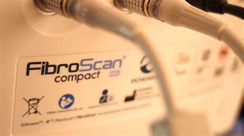 Launching Fibroscan An Innovative Painless And Non Invasive Procedure For Fattyliver