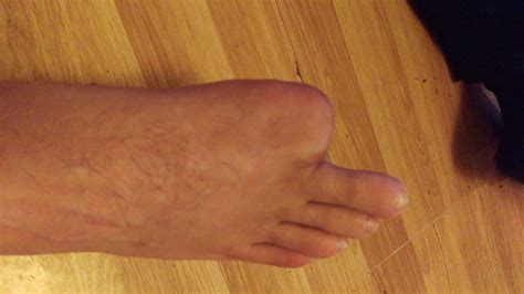 Toe Amputation Pictures Symptoms And Pictures