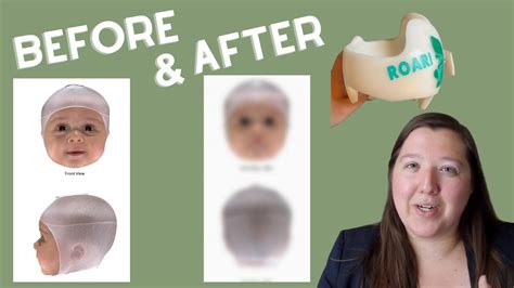 Carters Complete Doc Band Journey Before And After Plagiocephaly