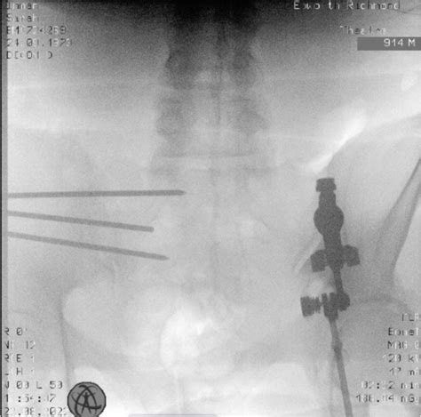 Minimally Invasive Surgery Mis Sacroiliac Si Joint Fusion Prof Aaron Buckland