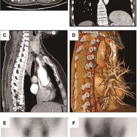 Computed Tomography Ct Scan And 99m Technetium Sestamibi Scanning Of