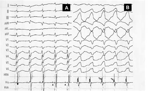 Intracardiac Electrograms And Surface Electrocardiograms During A Download Scientific Diagram
