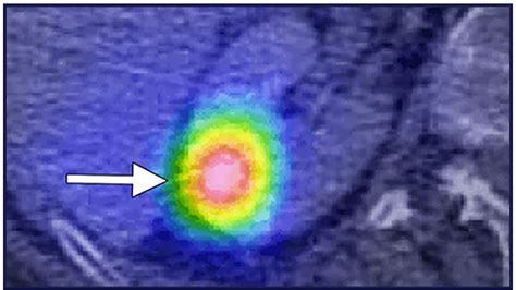 Ablative Radioembolization Of A Synchronous Renal Cell Carcinoma And