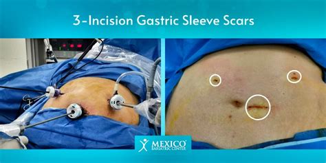 Laparoscopic Gastric Bypass Scars