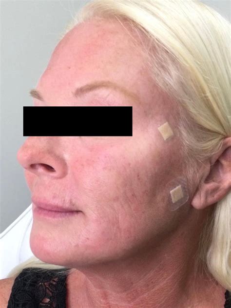 Pdo Thread CurateMD Skin Bar And Wellness Clinic