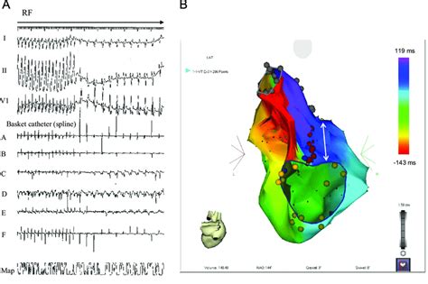 Catheter Ablation And Activation Mapping This Case Is The Same As The Download Scientific