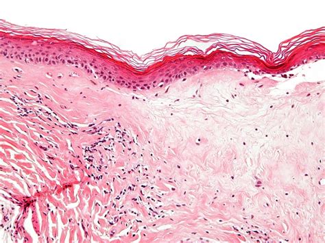 Баланит у мужчин Симптомы причины и лечение