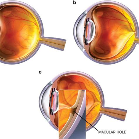A Redesigned Pathway For Vitreomacular Traction And Macular Hole