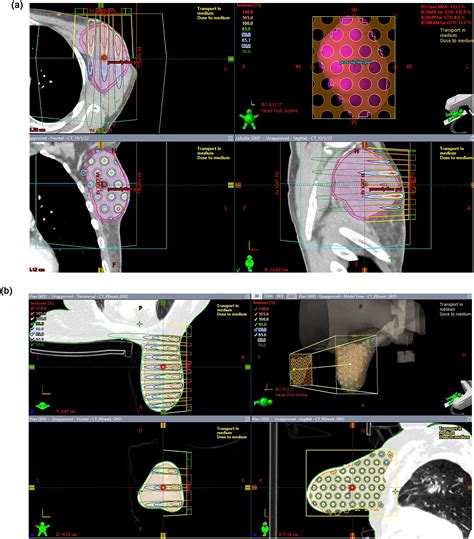 Dosimetric Validation For Prospective Clinical Trial Of Grid Collimator Based Spatially