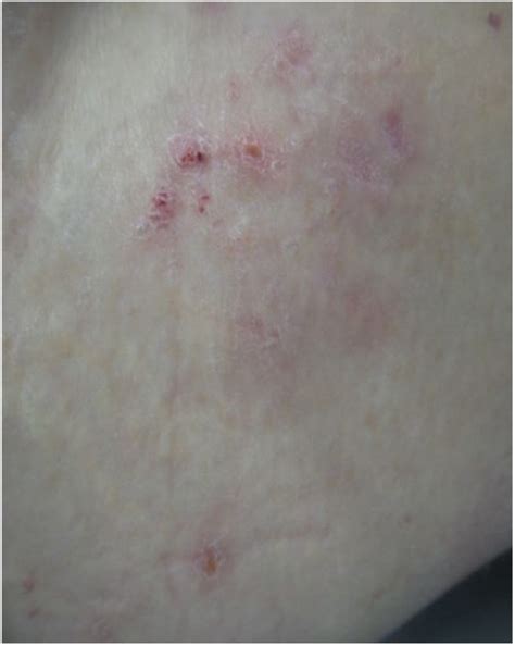 Acquired Widespread Lymphangiectasia Mimicking Immunobullous Disease A