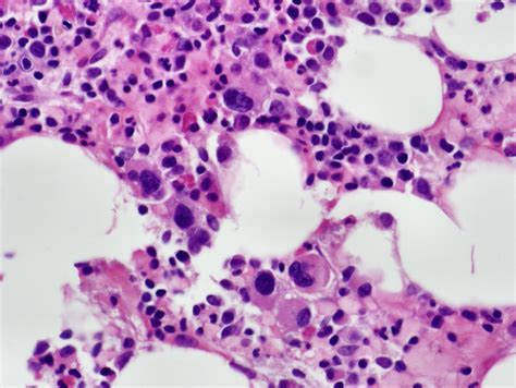 Storage Iron In Bone Marrow At Darla Ferguson Blog