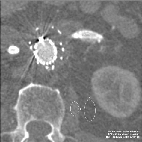 Figure 1 From The Value Of Metal Artifact Reduction And Iterative Algorithms In Dual Energy Ct