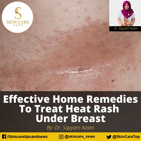 Effective Home Remedies To Treat Heat Rash Under Breast