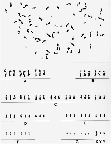 Chromosome Spread And Karyotype 3n ϭ 69xyy Of A Triploid Zygote