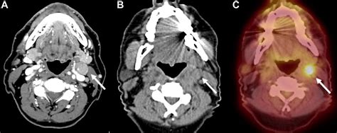Lymph Node Dissection Radiology Key