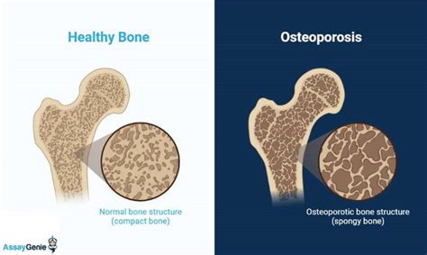Understanding Bone Resorption Key Definitions And Processes Assay Genie