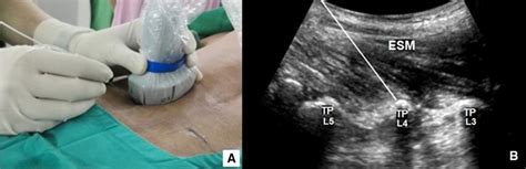 Ultrasound Guided Erector Spinae Plane Block Espb A Curved Download Scientific Diagram