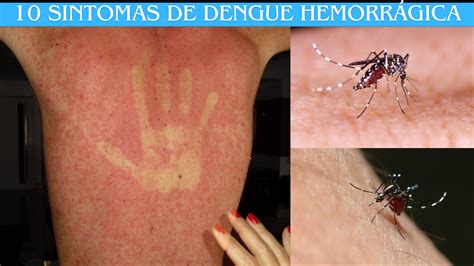 10 Sintomas De Dengue Hemorrágica