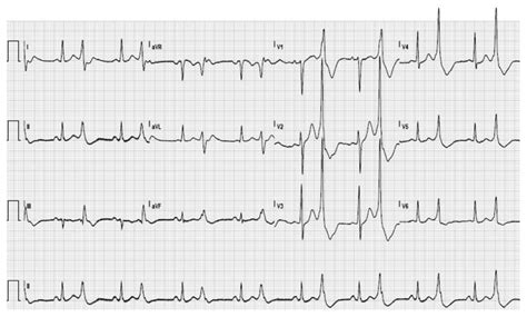 Long Qt Syndrome Type 2 And Type 6 In 37 Year Old Iraqi Woman
