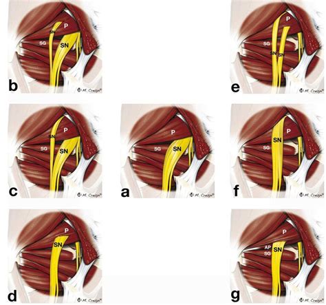 Dynamic Entrapment Of The Sciatic Nerve By The Piriformis