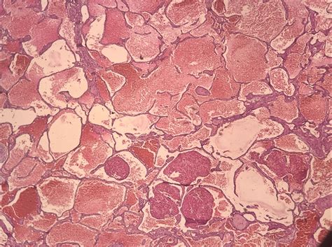 Cavernous Hemangioma Histopathology Guru