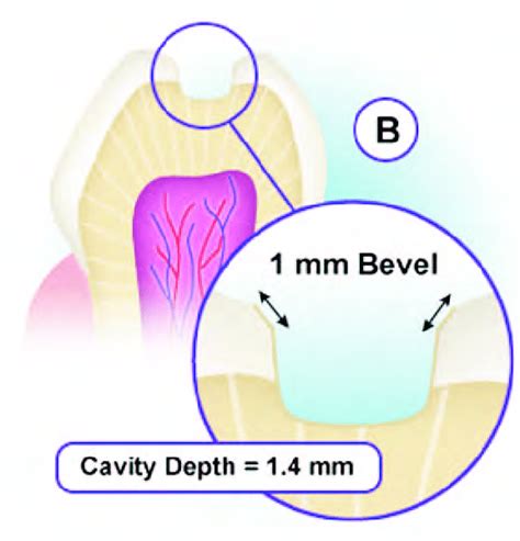 A Conventional Class I Preparation With No Bevel Download