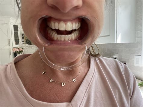 Byte Teeth Aligner Trial Before And After Review Just Simply Mom