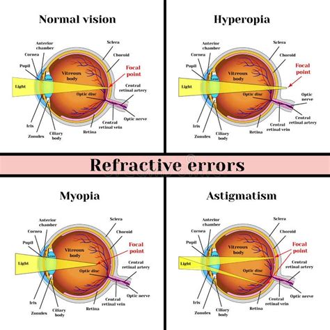 Refractive Errors Eyeball Hyperopia Myopia Astigmatism Stock Vector