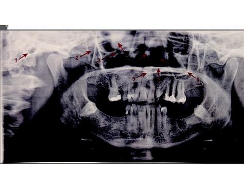 Fig 2902 Maxillary Landmarks Quiz