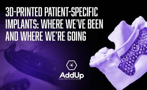 3d Printed Patient Specific Implants Where Weve Been And Where Were Going