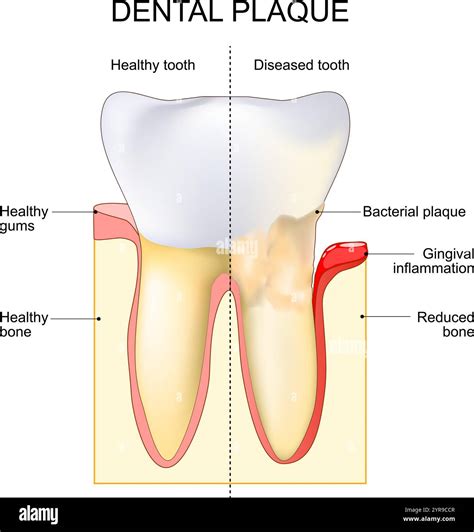 Dental Plaque Gingival Inflammation Near Bacterial Plaque Healthy