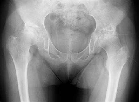 Camptodactyly Arthropathy Coxa Vara Pericarditis Syndrome Versus