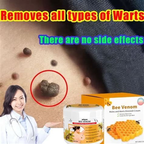Jual Salep Obat Kutil Paling Ampuh Wart Remover Bee Venom Penghilang
