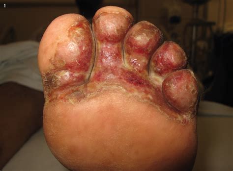 Pseudomonas Aeruginosa Skin Infection