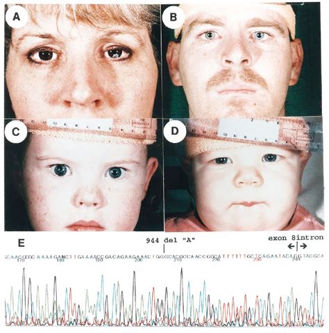 Waardenburg Syndrome Type 2 Semantic Scholar