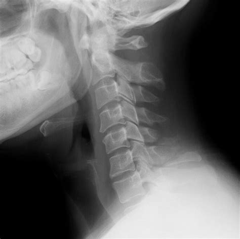 Cervical Spine Hyperflexion Injuries By Alexander Baxter