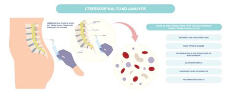 Cerebrospinal Fluid Csf Leak Symptoms And Treatment Advanced Brain And Spine
