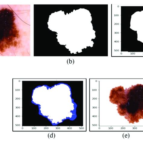 Segmentation Of The Dermoscopic Image By The Proposed Method A