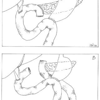 Single Loop Reconstruction A And Double Loop Reconstruction B Download Scientific Diagram
