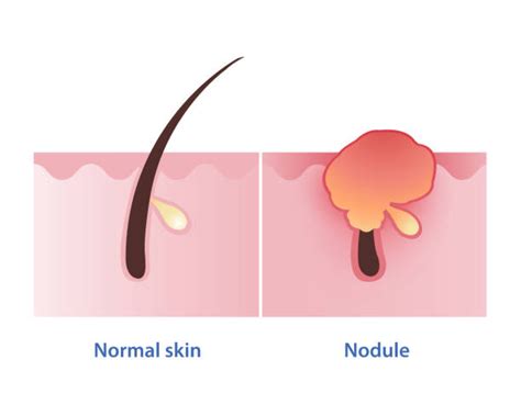 Nodule Pimple Causes Deep Lesions Triggers
