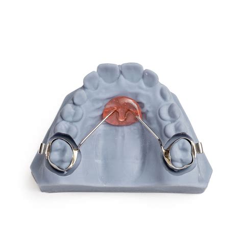 Nance Appliance Motif Orthodontic Arts