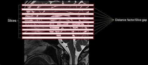 Mri Distance Factor Slice Gap