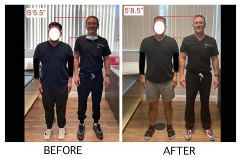 Height Lengthening Surgery Before And After Gallery Height Lengthening
