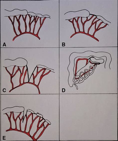 classification of jejuno ileal atresia a type 1 b type 2 c type 3a
