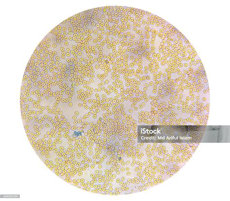 Células Sanguíneas Humanas Bajo Un Microscopio Puede Ver Eritrocitos Glóbulos Rojos Foto De