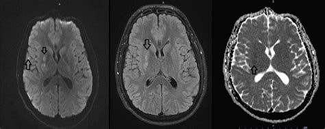 Diffusion Weight DW MRI On The Left Showing Areas Of Restricted Download Scientific Diagram
