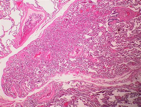 Atelectasis A Photo On Flickriver