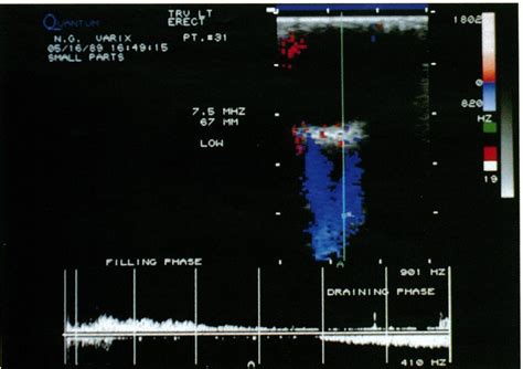 Spectral Analysis Of The Varix Demonstrates The Filling Phase Above Download Scientific