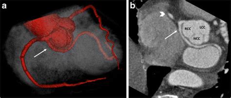 A LCx Artery White Arrow Arising From The Proximal RCA Following A Download Scientific