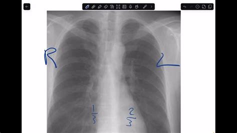 Dextrocardia Vs Situs Inversus Radiology Youtube